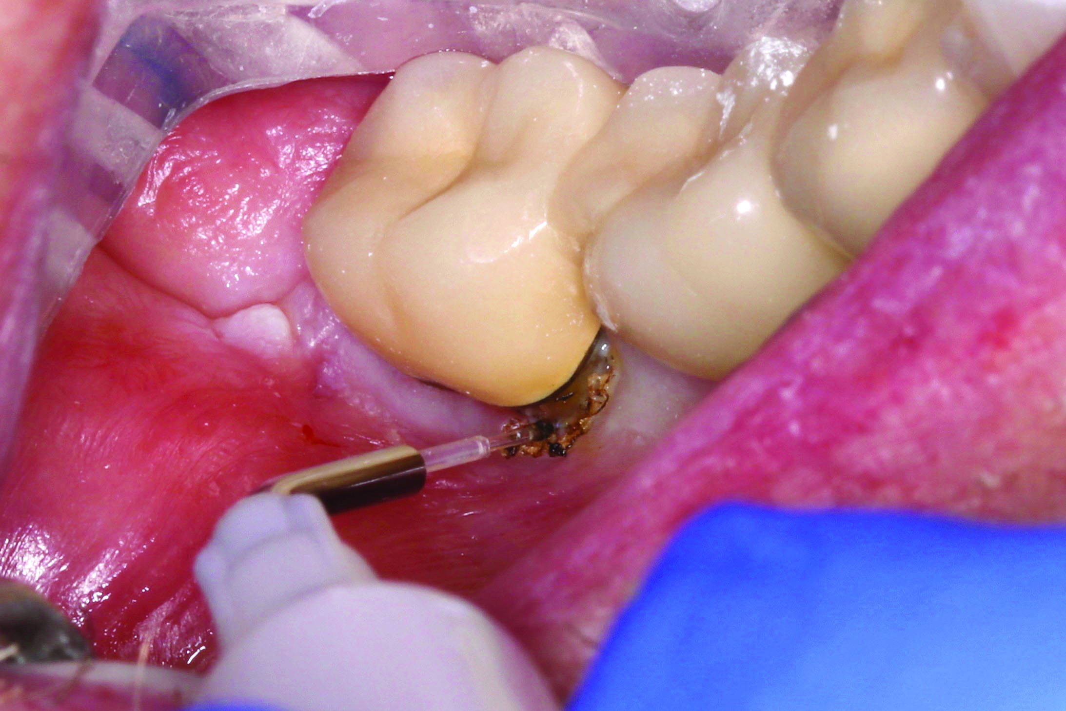 Utilizing A Soft Tissue Diode Laser For A Direct Resin Restoration